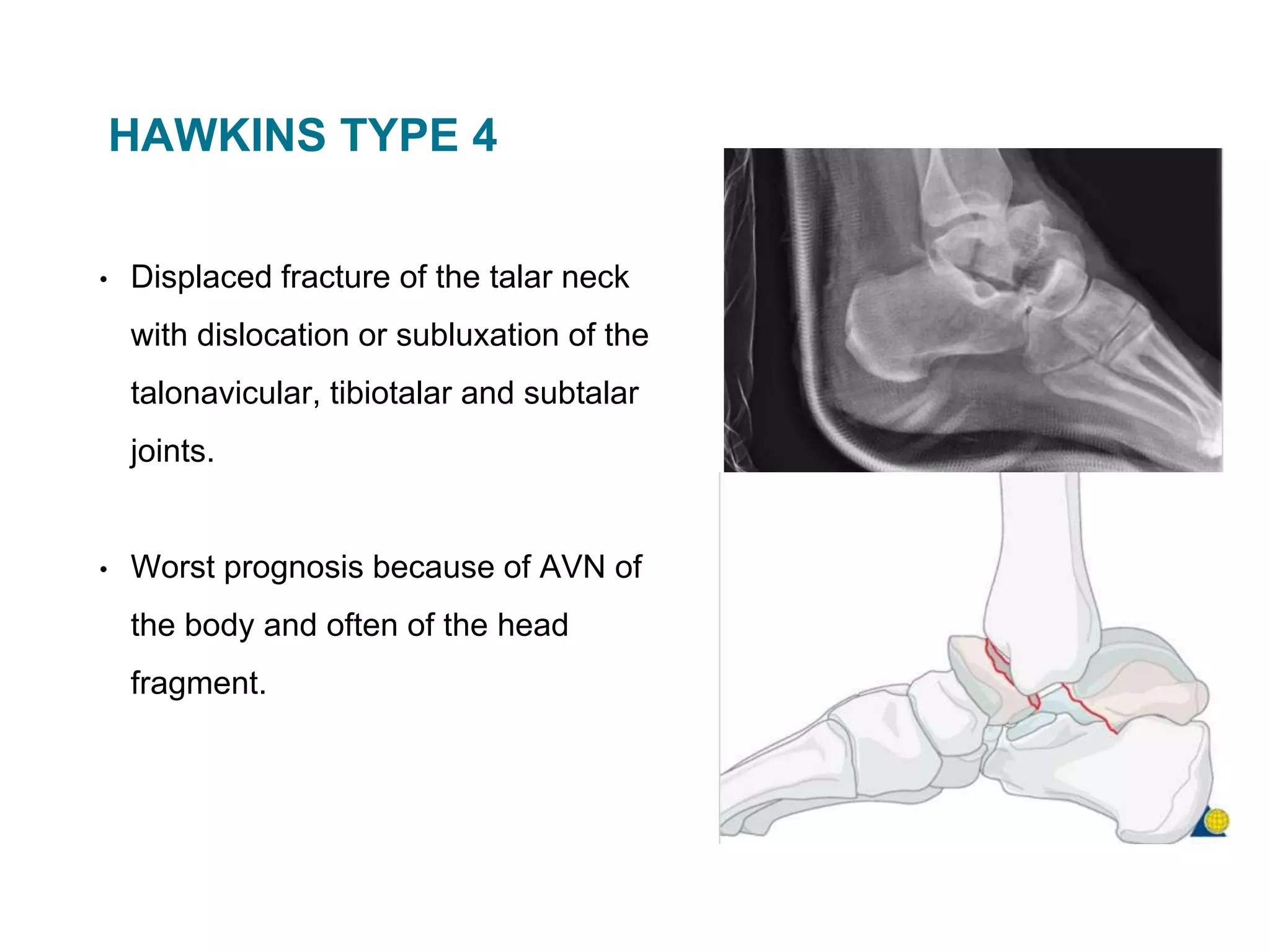 Talus fracture treatment algorithm | PPT