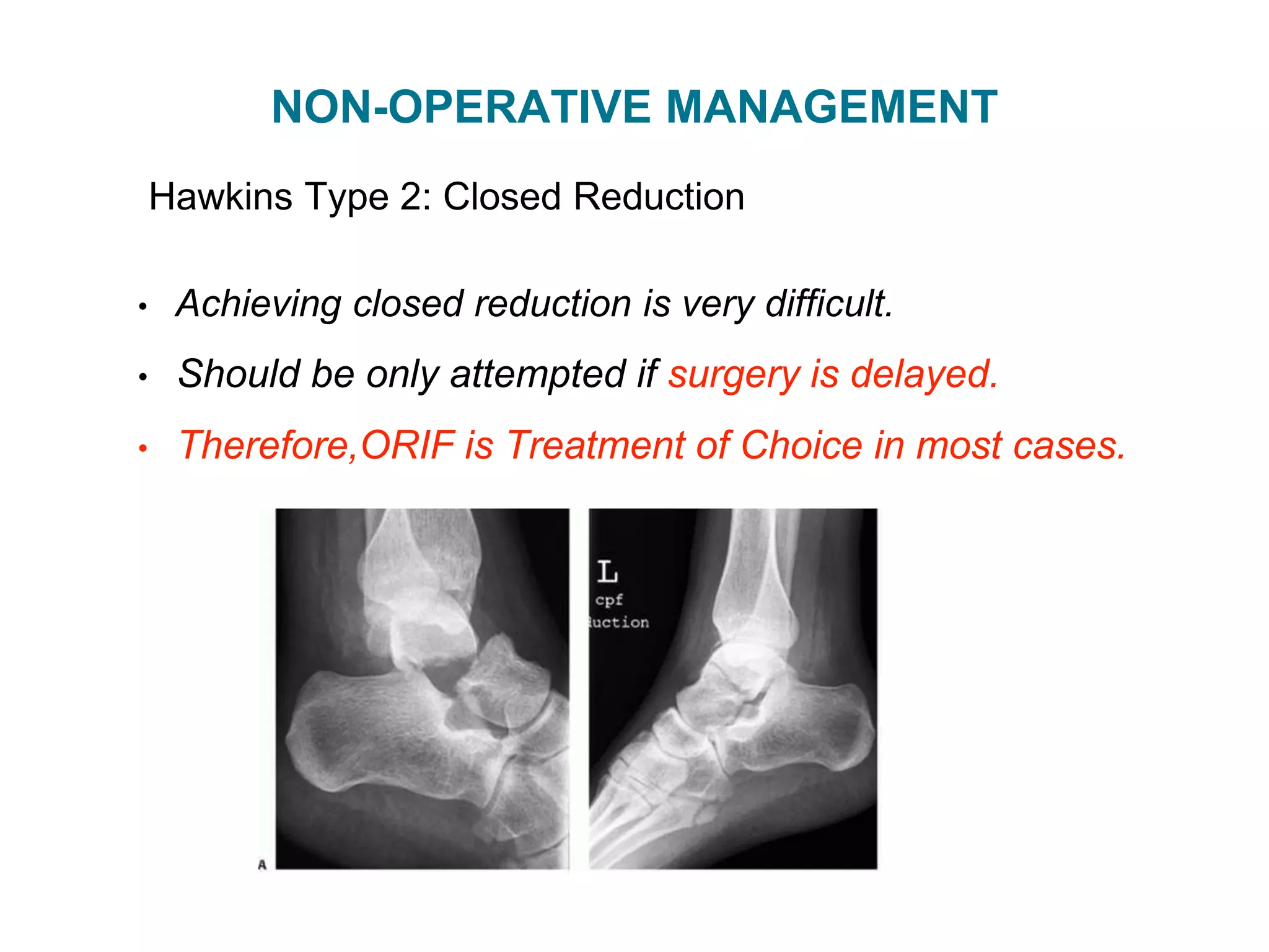 Talus fracture treatment algorithm | PPTX | Death, Injury, or Military ...