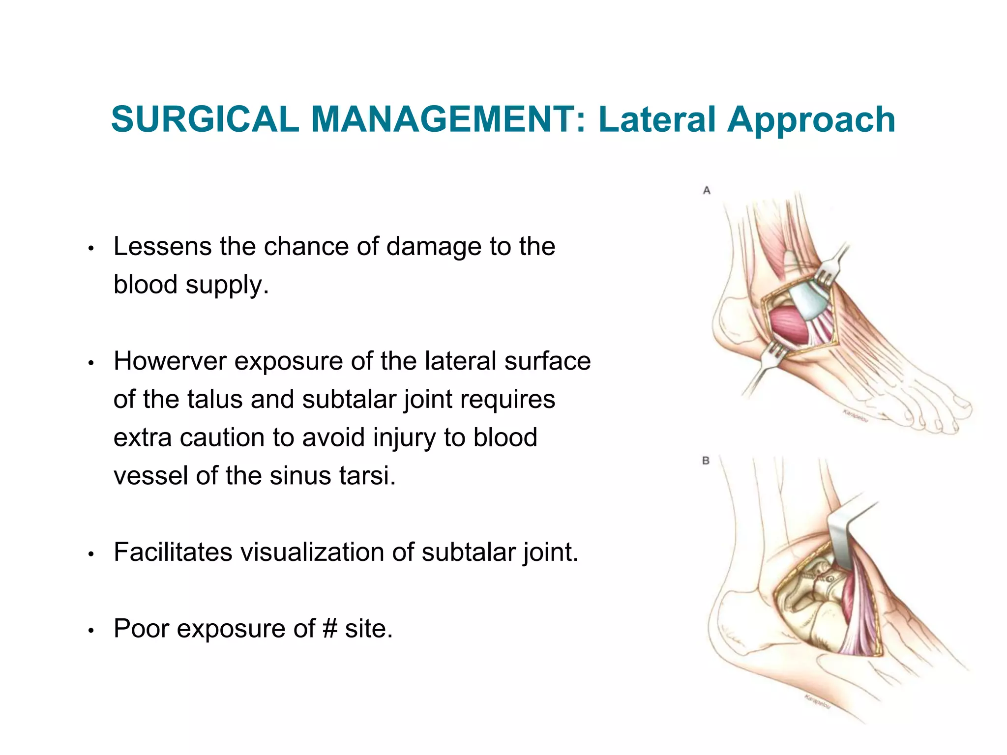 Talus fracture treatment algorithm | PPTX | Death, Injury, or Military ...