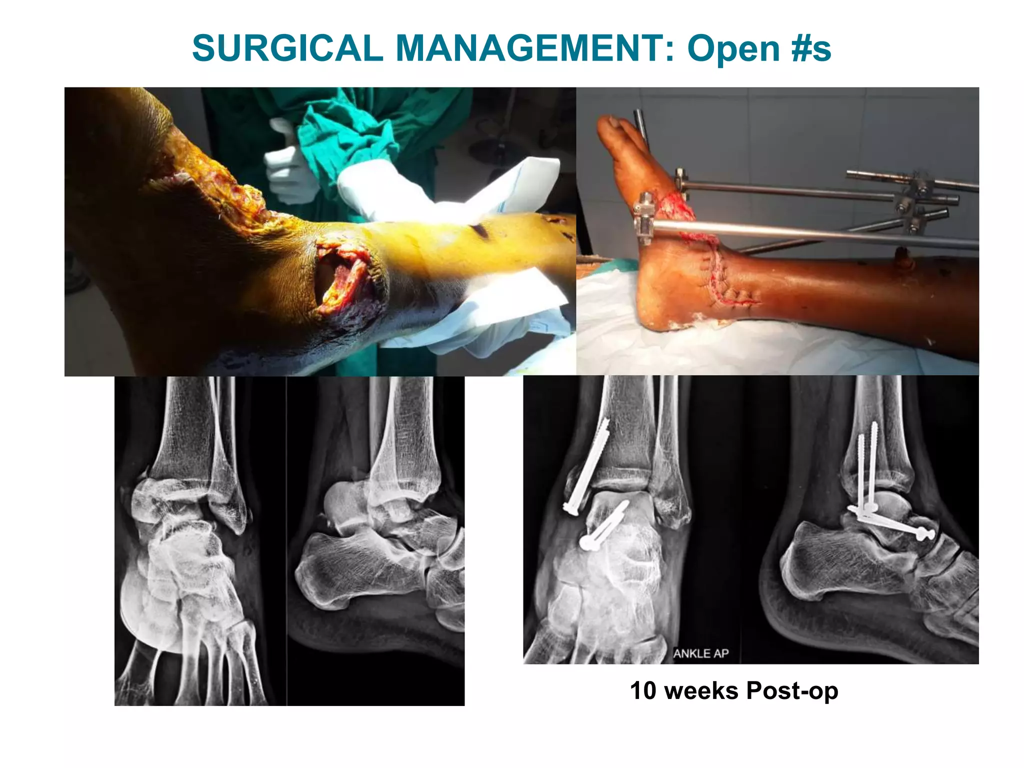 Talus fracture treatment algorithm | PPTX