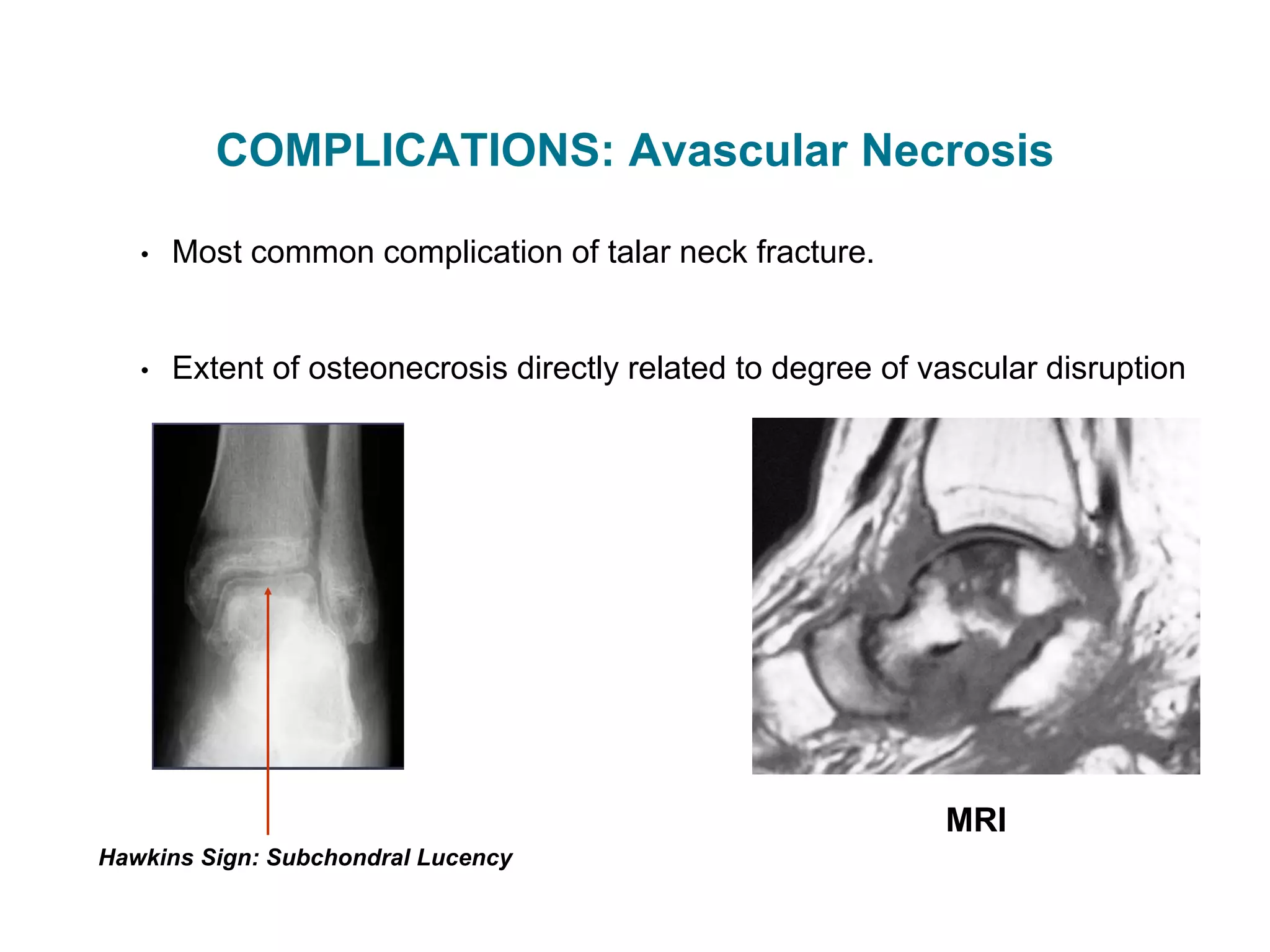 Talus fracture treatment algorithm | PPTX