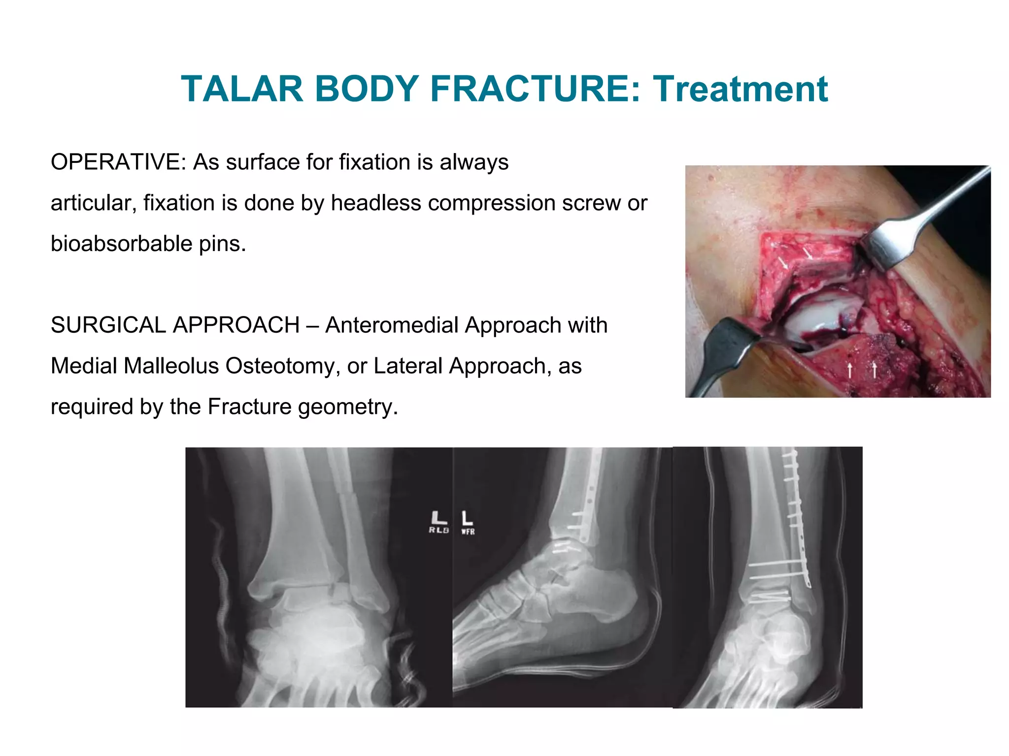 Talus fracture treatment algorithm | PPTX | Death, Injury, or Military ...