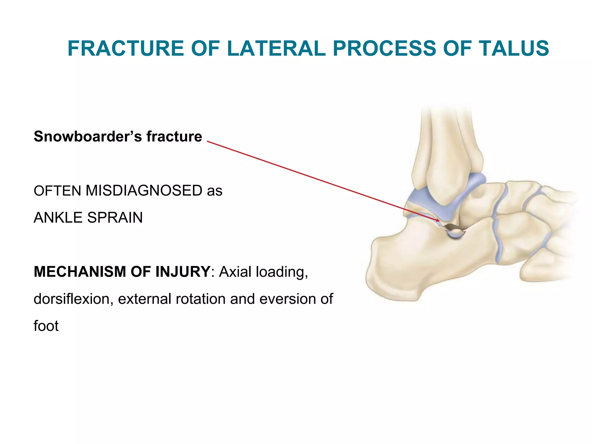 Talus fracture treatment algorithm | PPTX | Death, Injury, or Military Conflict | Sensitive Topics