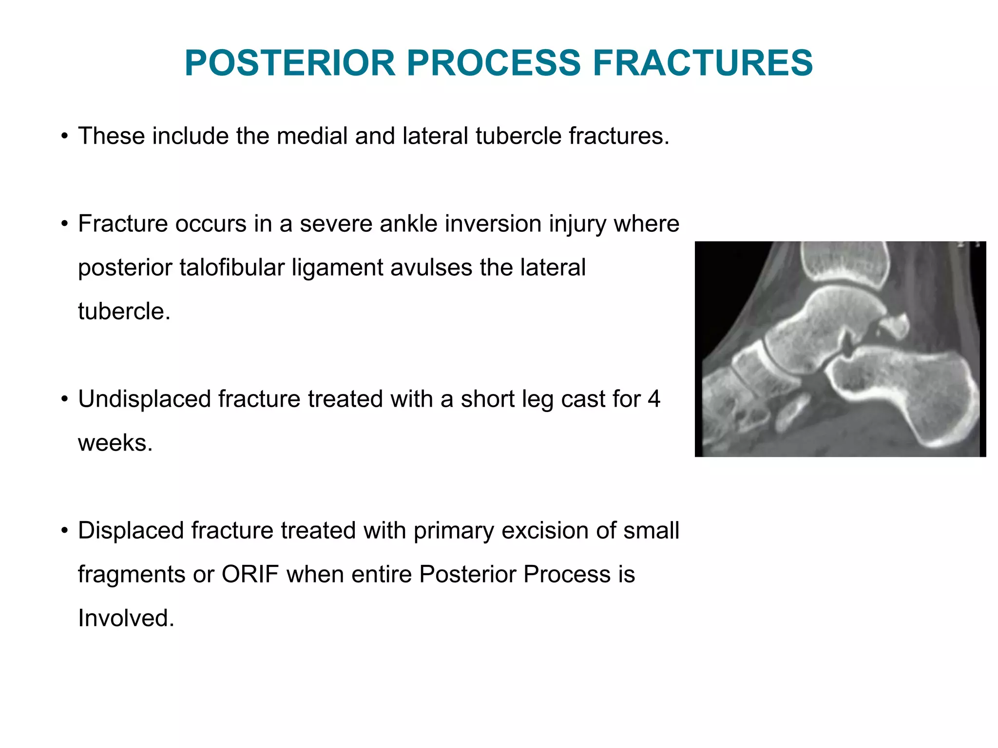 Talus fracture treatment algorithm | PPTX