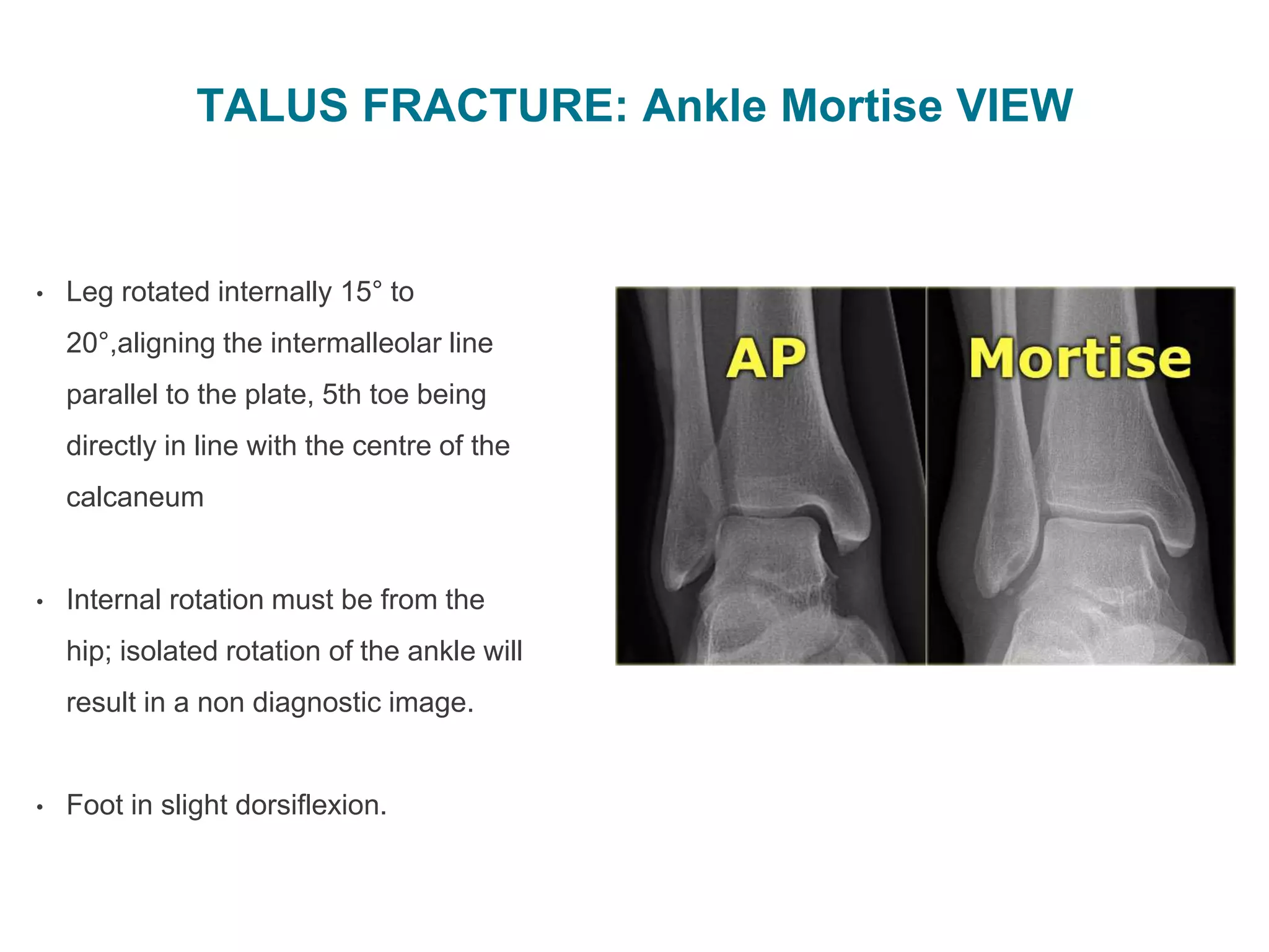 Talus fracture treatment algorithm | PPT