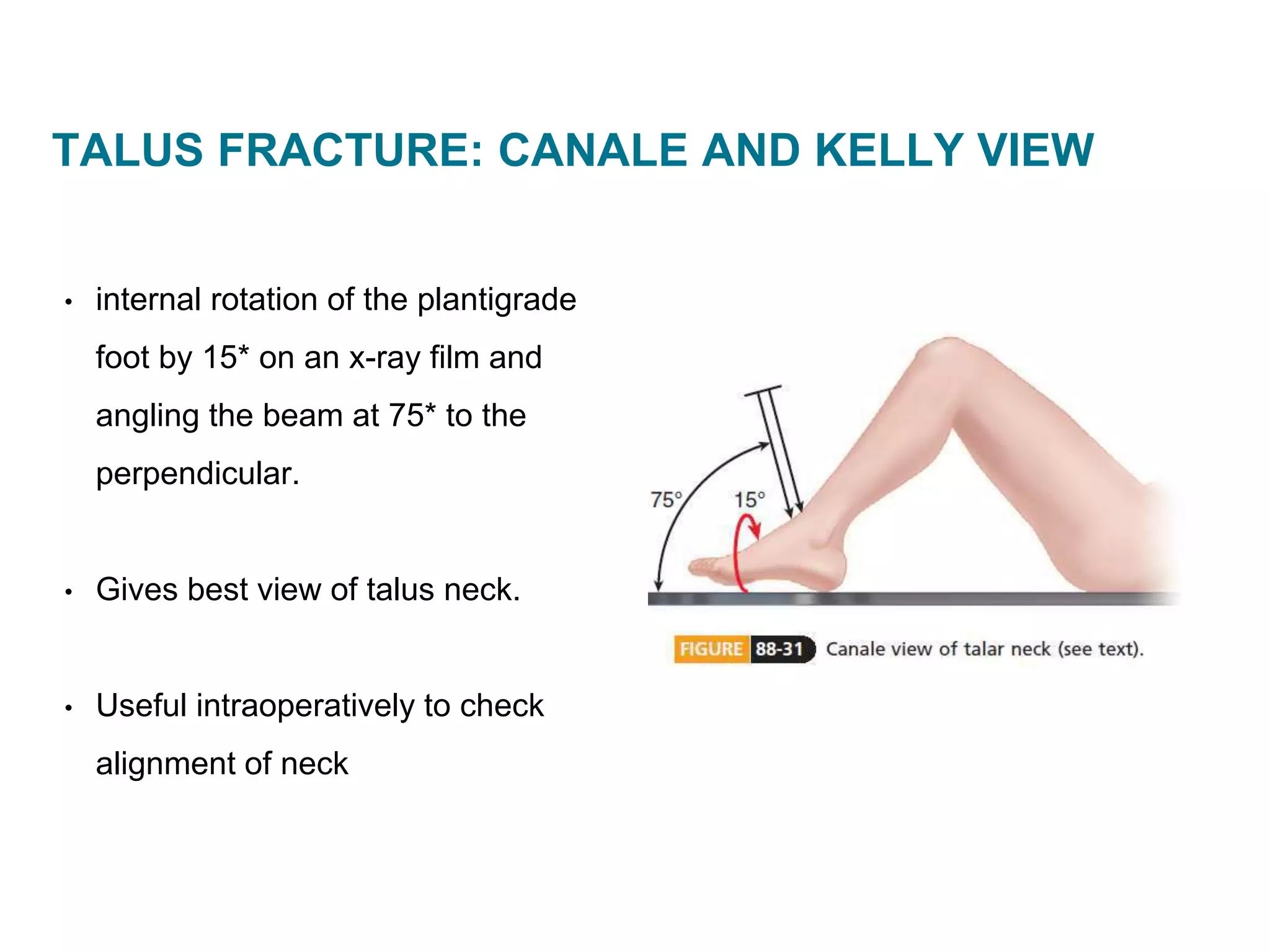 Talus fracture treatment algorithm | PPTX | Death, Injury, or Military ...
