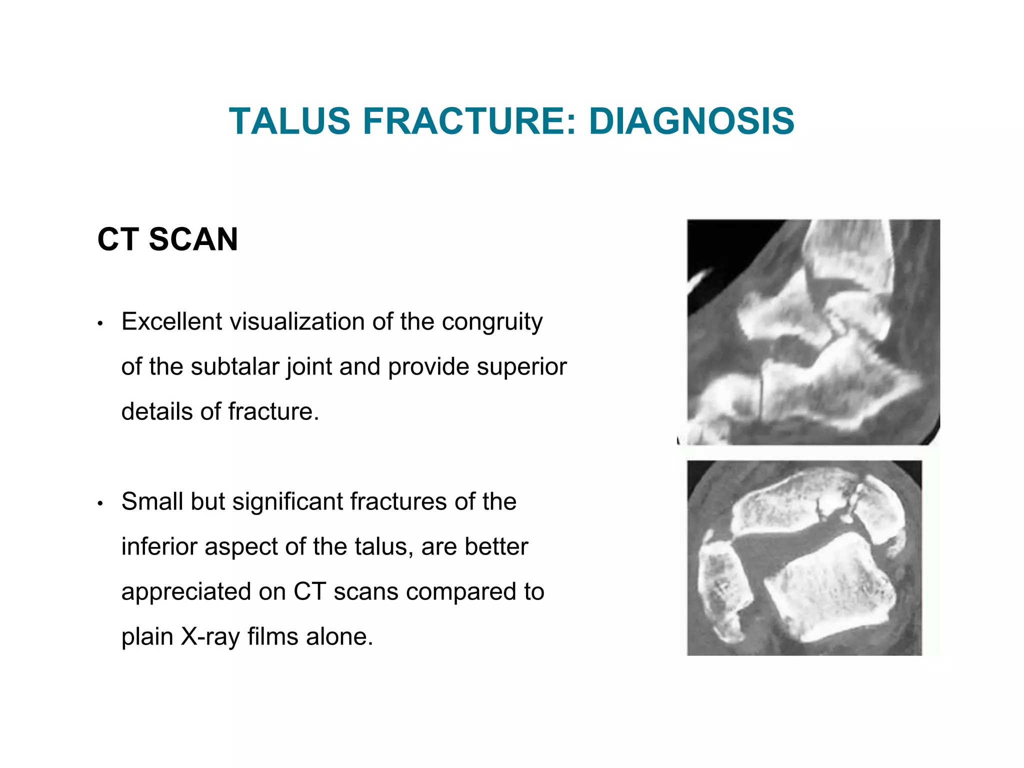 Talus fracture treatment algorithm | PPTX | Death, Injury, or Military ...