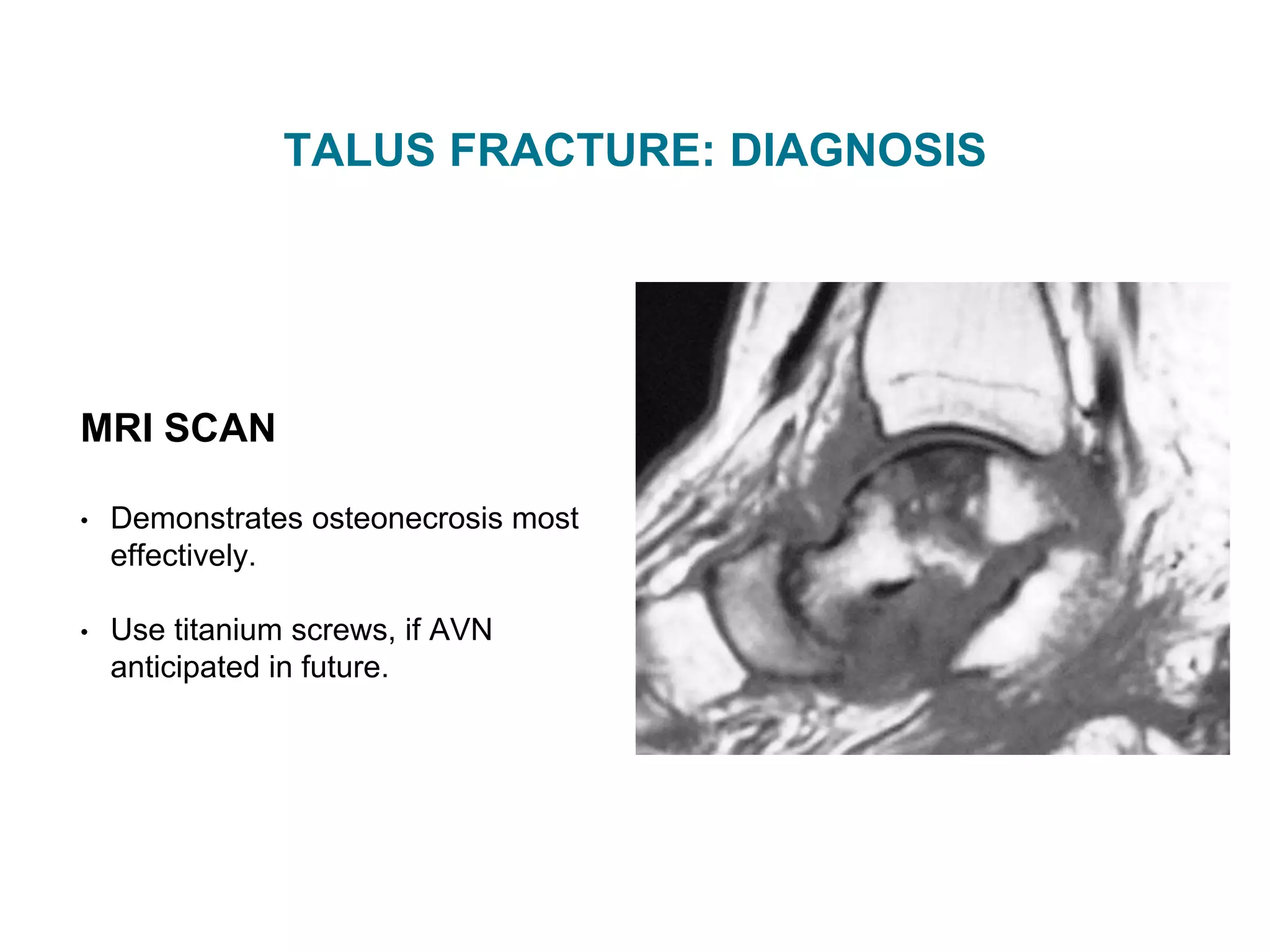 Talus fracture treatment algorithm | PPTX