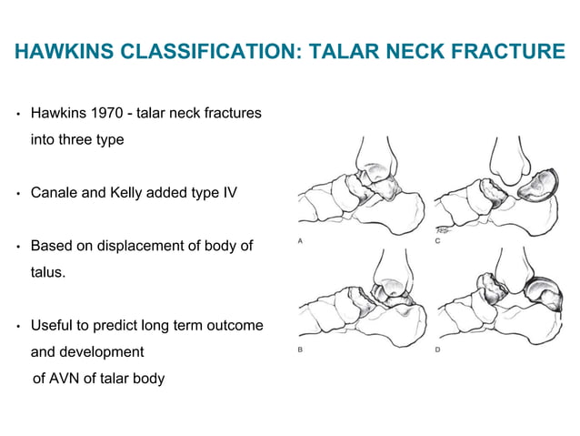 Talus fracture treatment algorithm | PPT