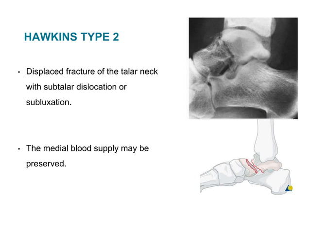 Talus fracture treatment algorithm | PPT