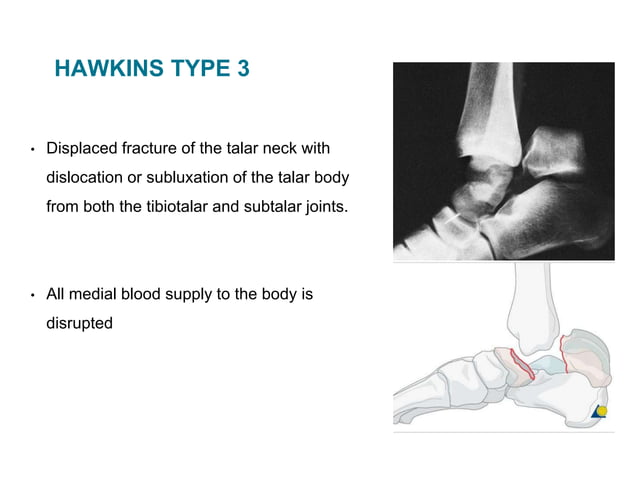 Talus fracture treatment algorithm | PPT