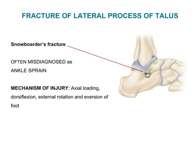 Talus fracture treatment algorithm | PPT