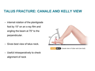 Talus fracture treatment algorithm | PPTX | Death, Injury, or Military ...