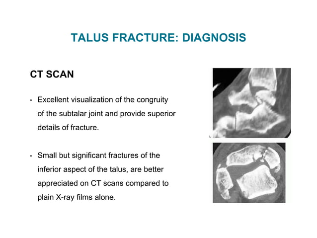 Talus fracture treatment algorithm | PPT