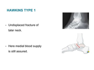 Types Of Talus Fractures