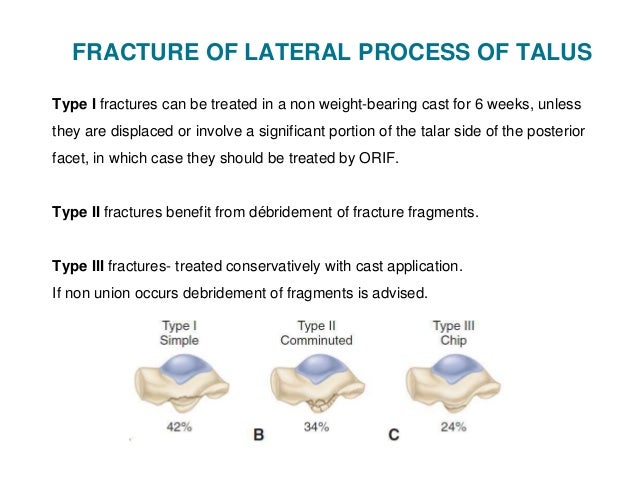 Talus fracture treatment algorithm