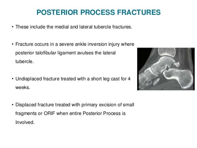 Talus fracture treatment algorithm