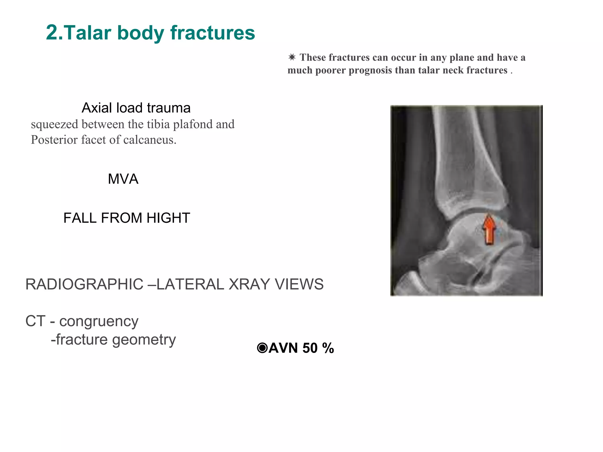 Talus fructures classification and managment | PPTX