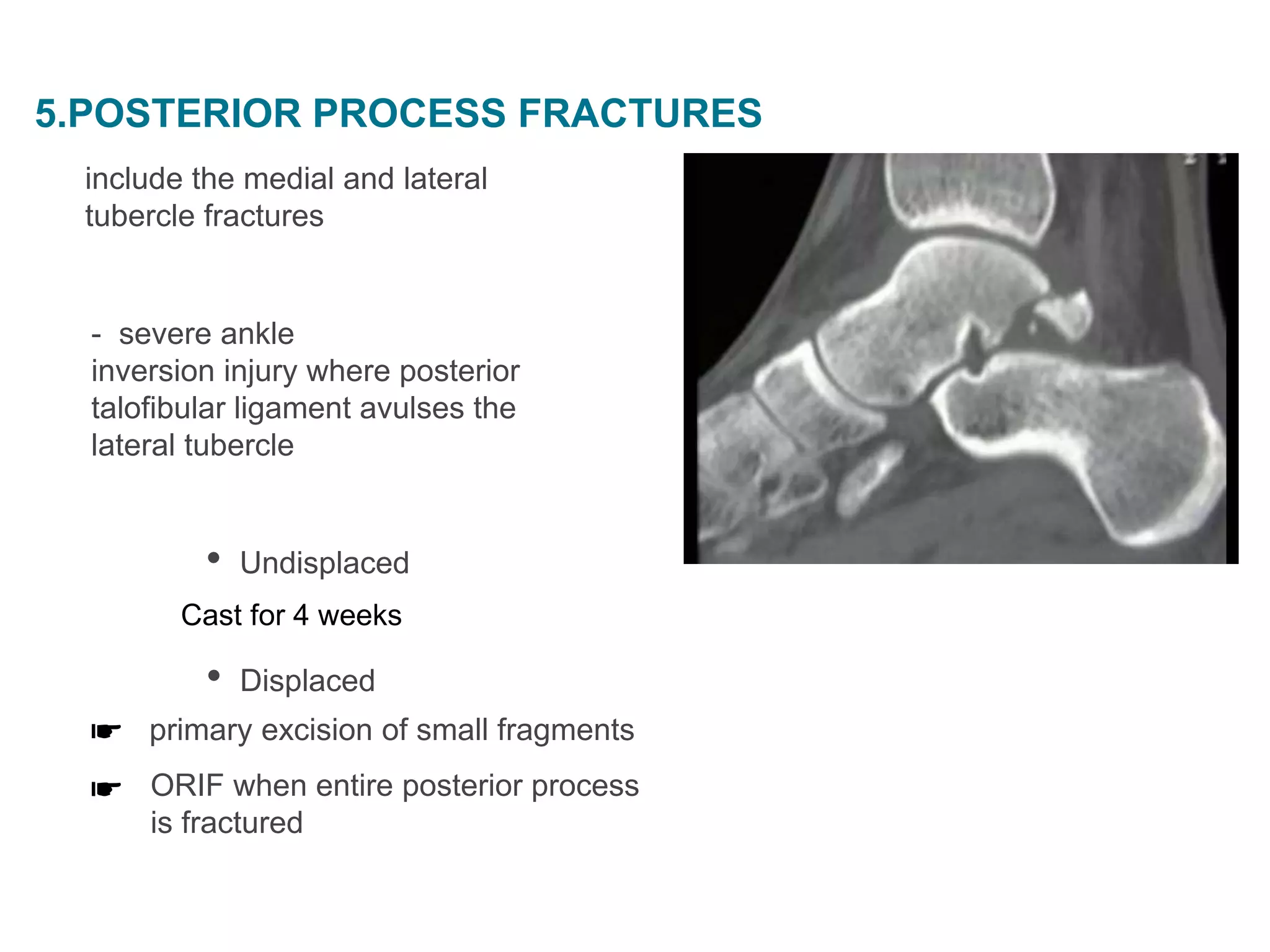 Talus fructures classification and managment | PPTX