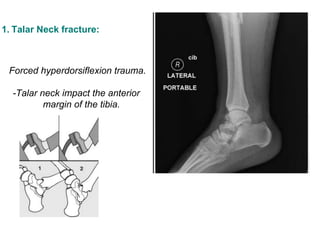 Talus fructures classification and managment | PPTX