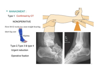 Talus fructures classification and managment | PPTX