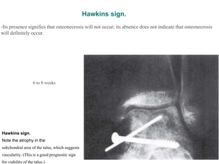 Talus fructures classification and managment | PPTX