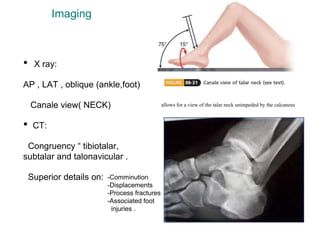 Talus fructures classification and managment | PPTX