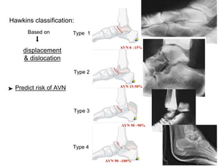 Talus fructures classification and managment | PPT