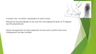TALUS fracture principles and management.ppt