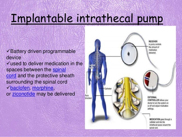 Implantable polymer based drug delivery system for tailored drug rele…