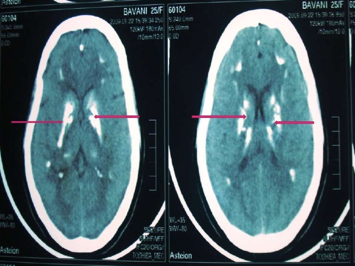 CT: Basal Ganglia Calcification CT: Basal Ganglia Calcification