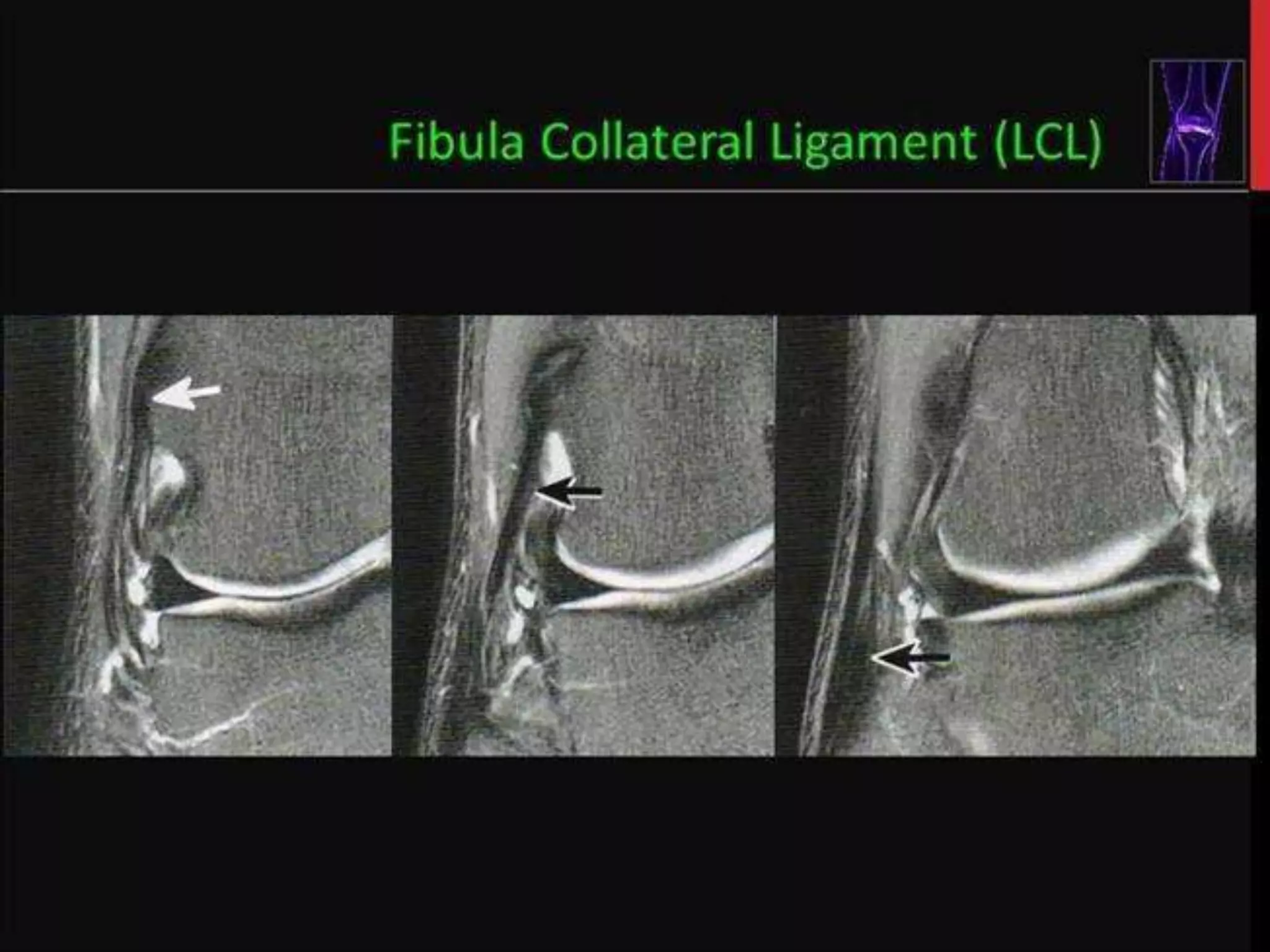 LIGAMENTOUS ANATOMY OF KNEE | PPTX