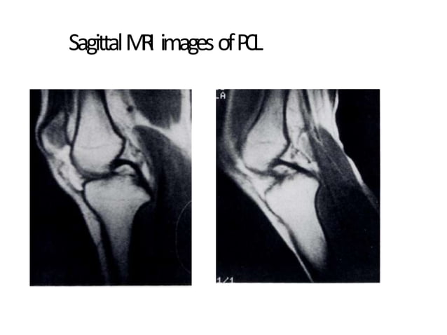 LIGAMENTOUS ANATOMY OF KNEE | PPTX