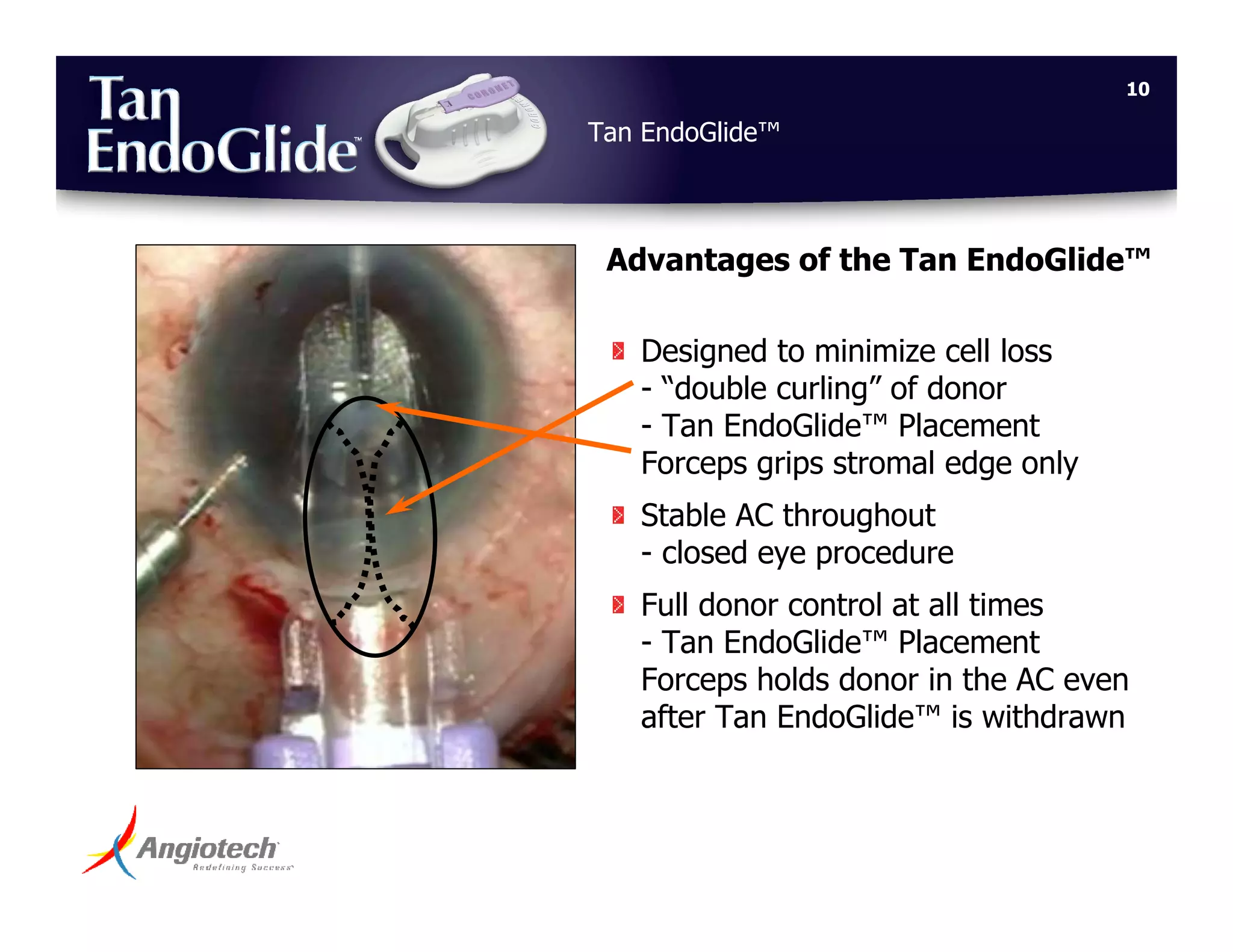 Tan endoglide for lamellar surgery, DSAEK | PDF