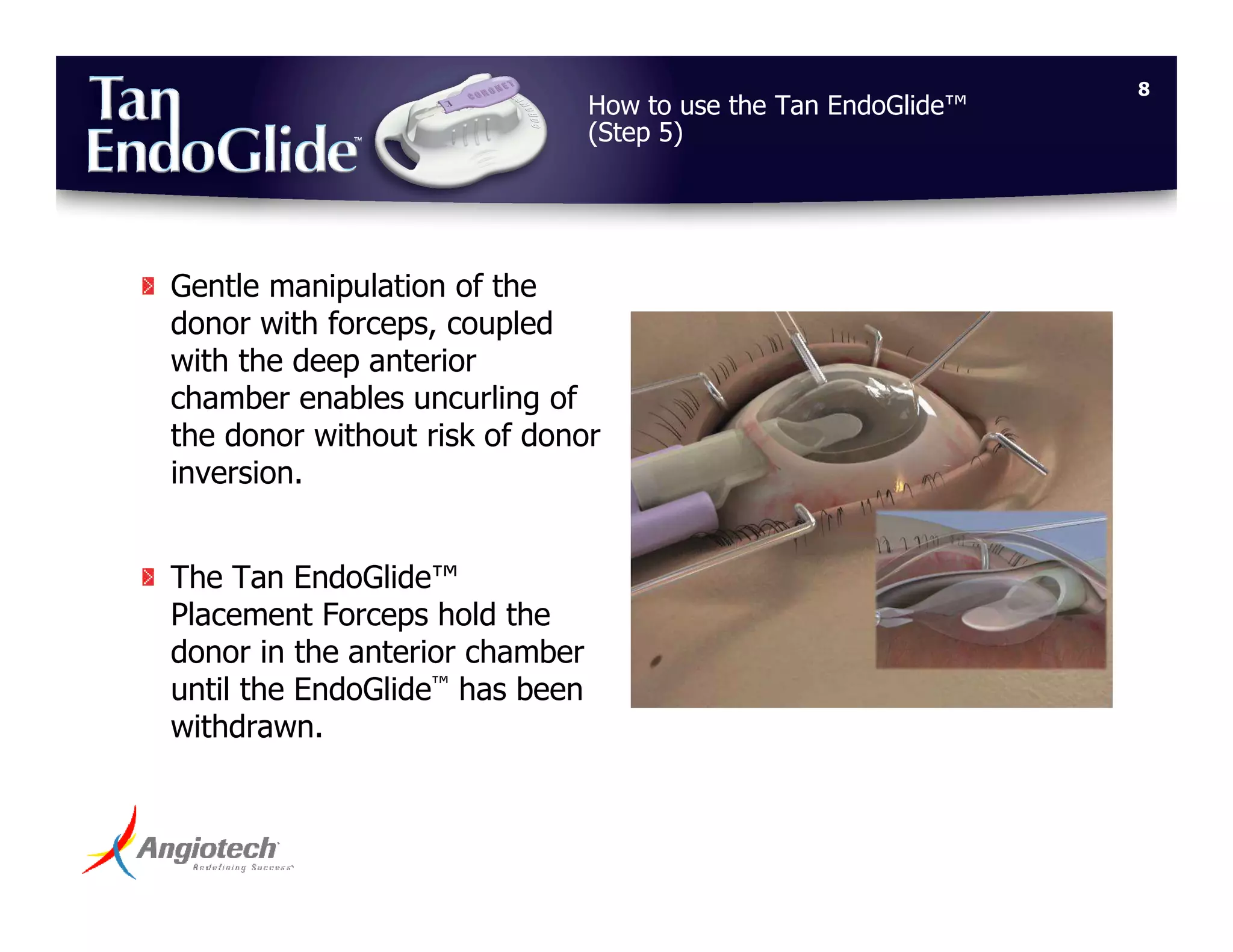 Tan endoglide for lamellar surgery, DSAEK | PDF