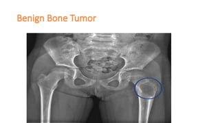 Bone Tumor | PPTX