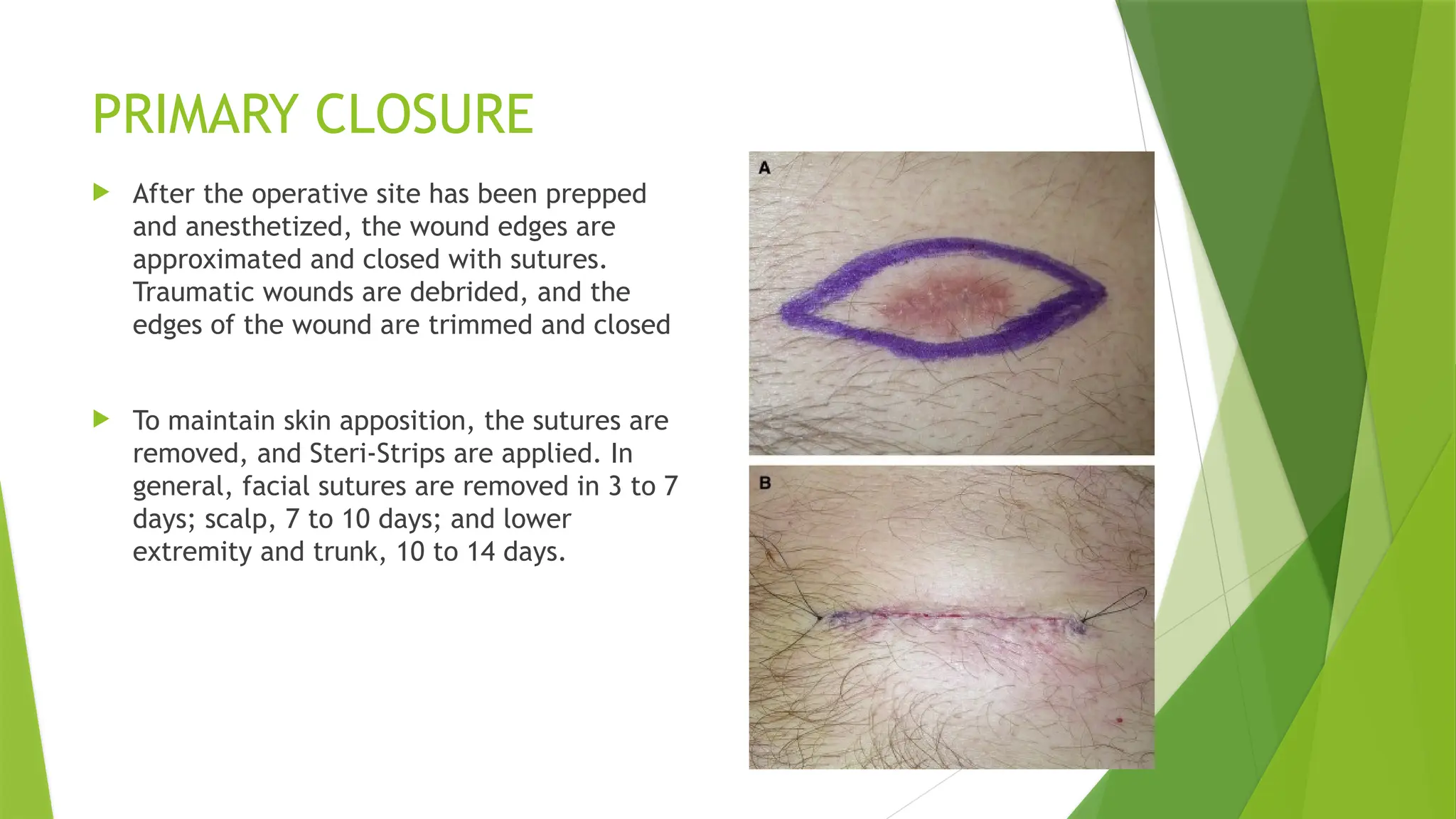 penutupan luka penutupan luka penutupan luka | PPTX