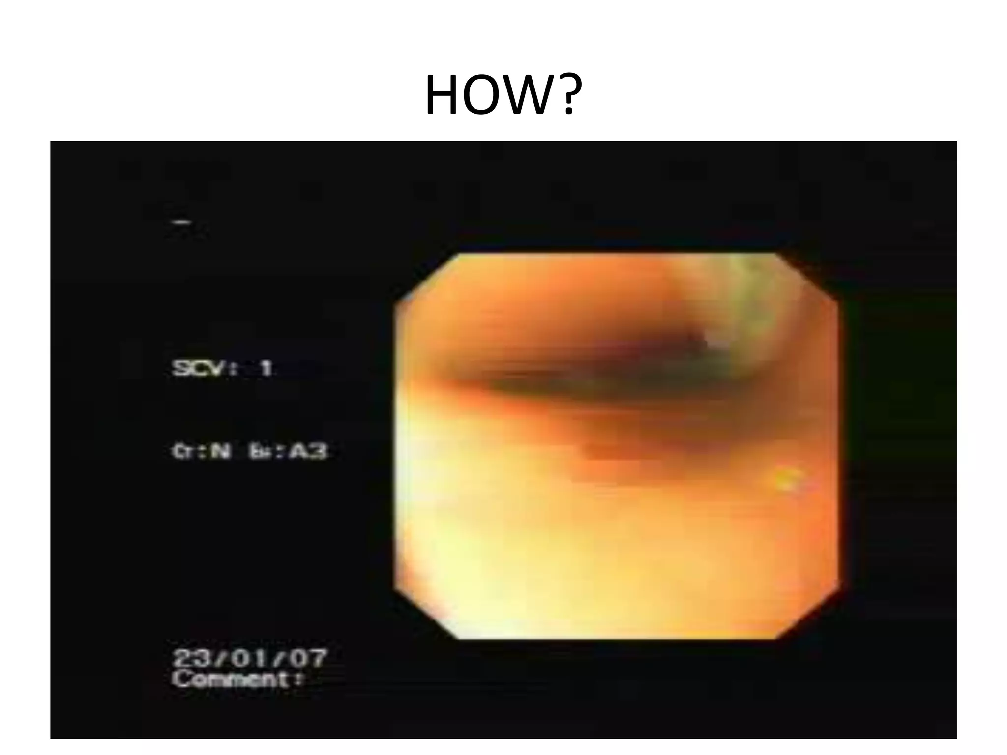 Metabolic Endoscopy Intragastric Balloon | PPTX