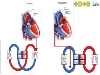 critical congenital heart disease | PPTX