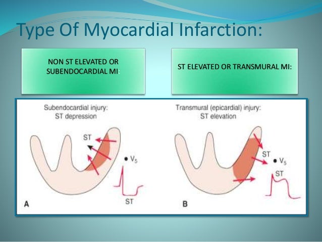 Dr. Tanzeel Araf Anik's Presentation about Myocardial Infarction.