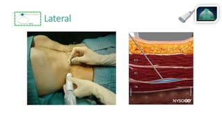 Ultrasound-Guided Transversus Abdominis Plane Blocks | PPTX