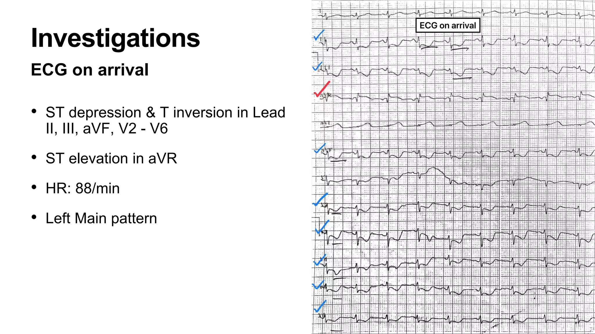 Allergy Induced Myocardial Infarction - Kounis Syndrome / Coronary ...