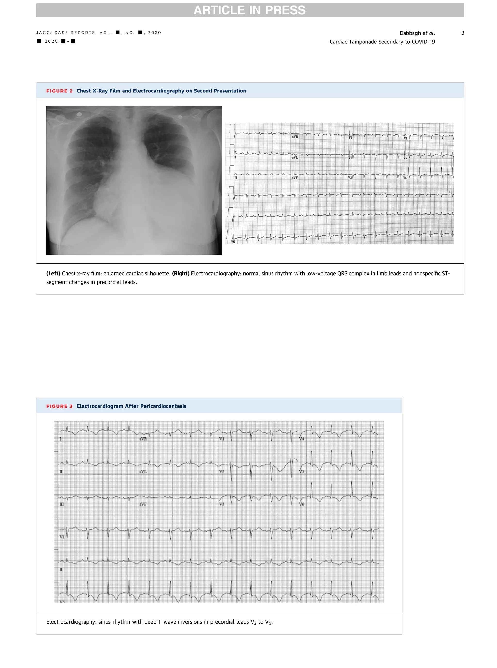Taponamiento cardica covid | PDF