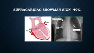 Total anomalous pulmonary venous connection | PPTX