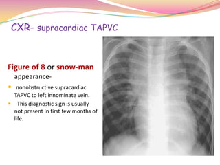 Total anomalous pulmonary venous connections seminar ppt. | PPTX