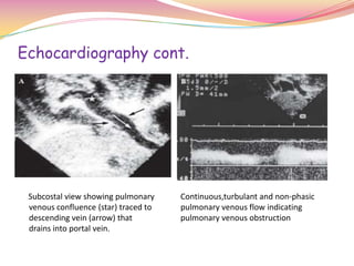 Total anomalous pulmonary venous connections seminar ppt. | PPTX