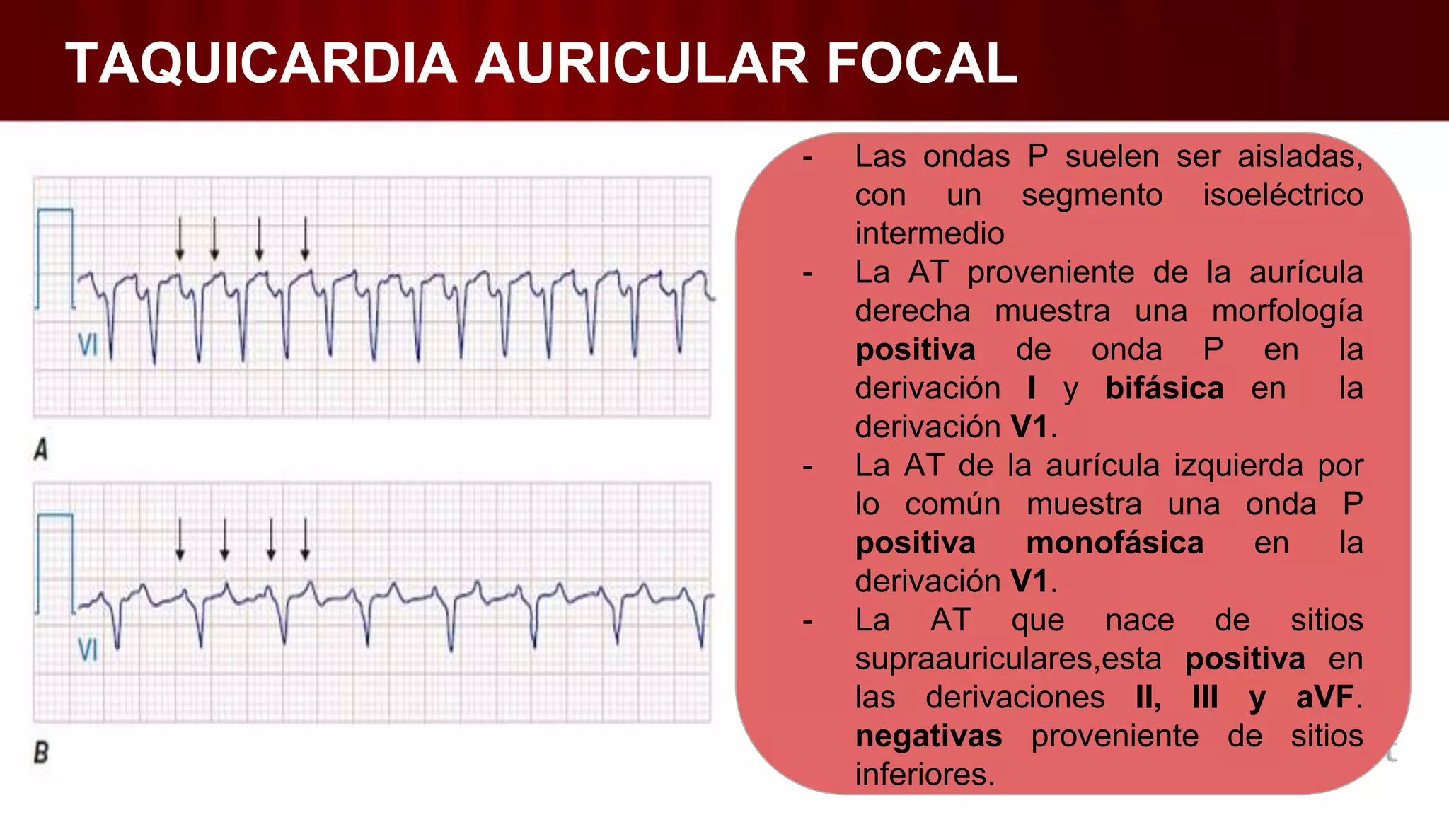 Tipos de Taquiarritmias