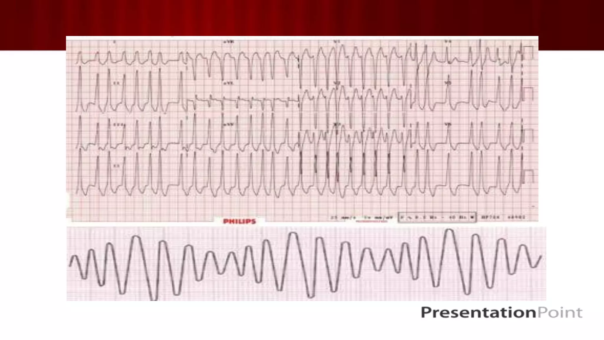 Tipos de Taquiarritmias