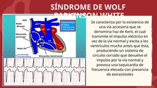 taquiarritmias denis.pptx cardiacaxs medicina | PPTX