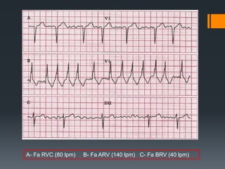 Taquiarritmias qrs angosto | PPTX